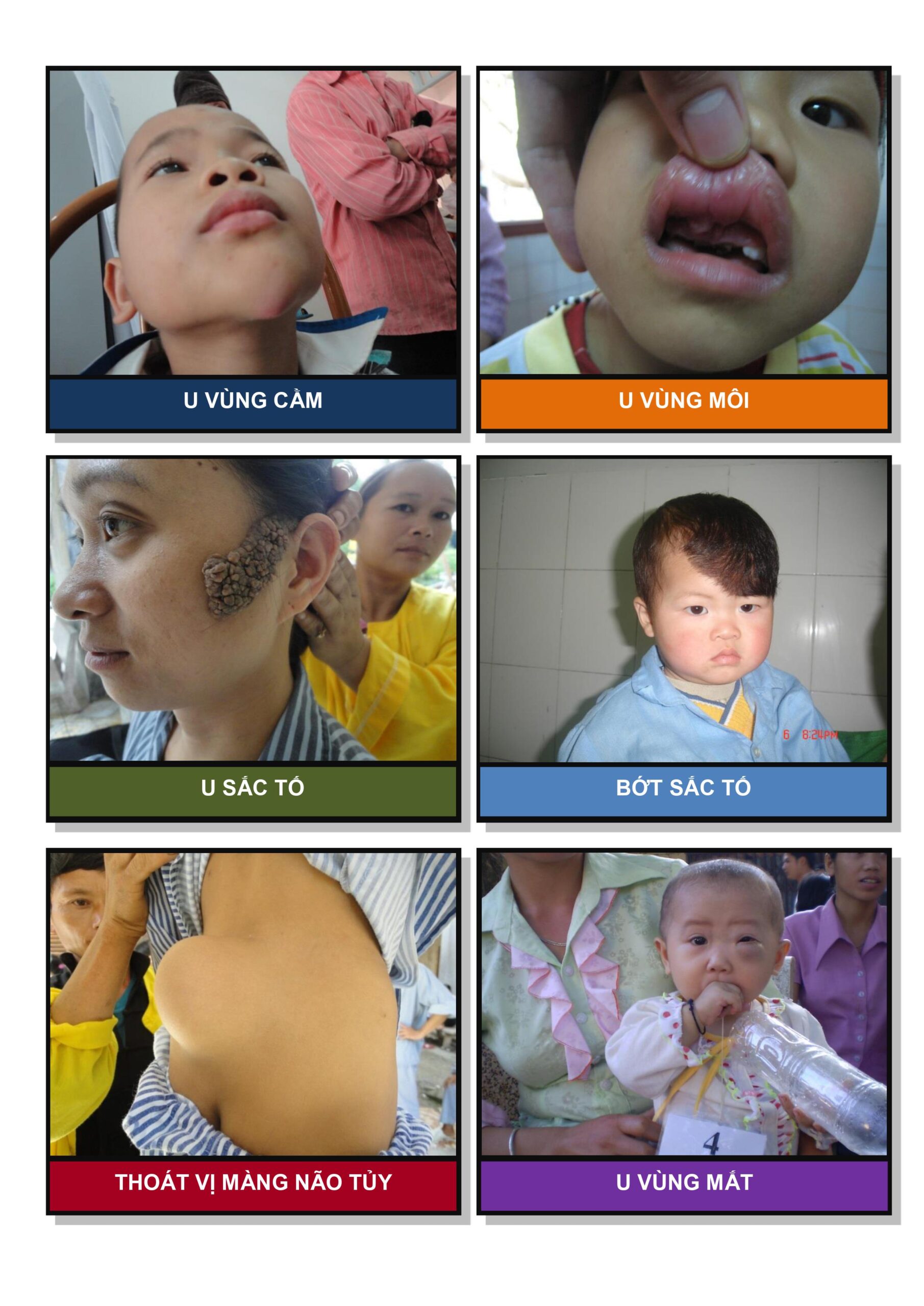 Nhận dạng trẻ khuyết tật có nhu cầu phẫu thuật Trung tâm II – Địa chỉ ...