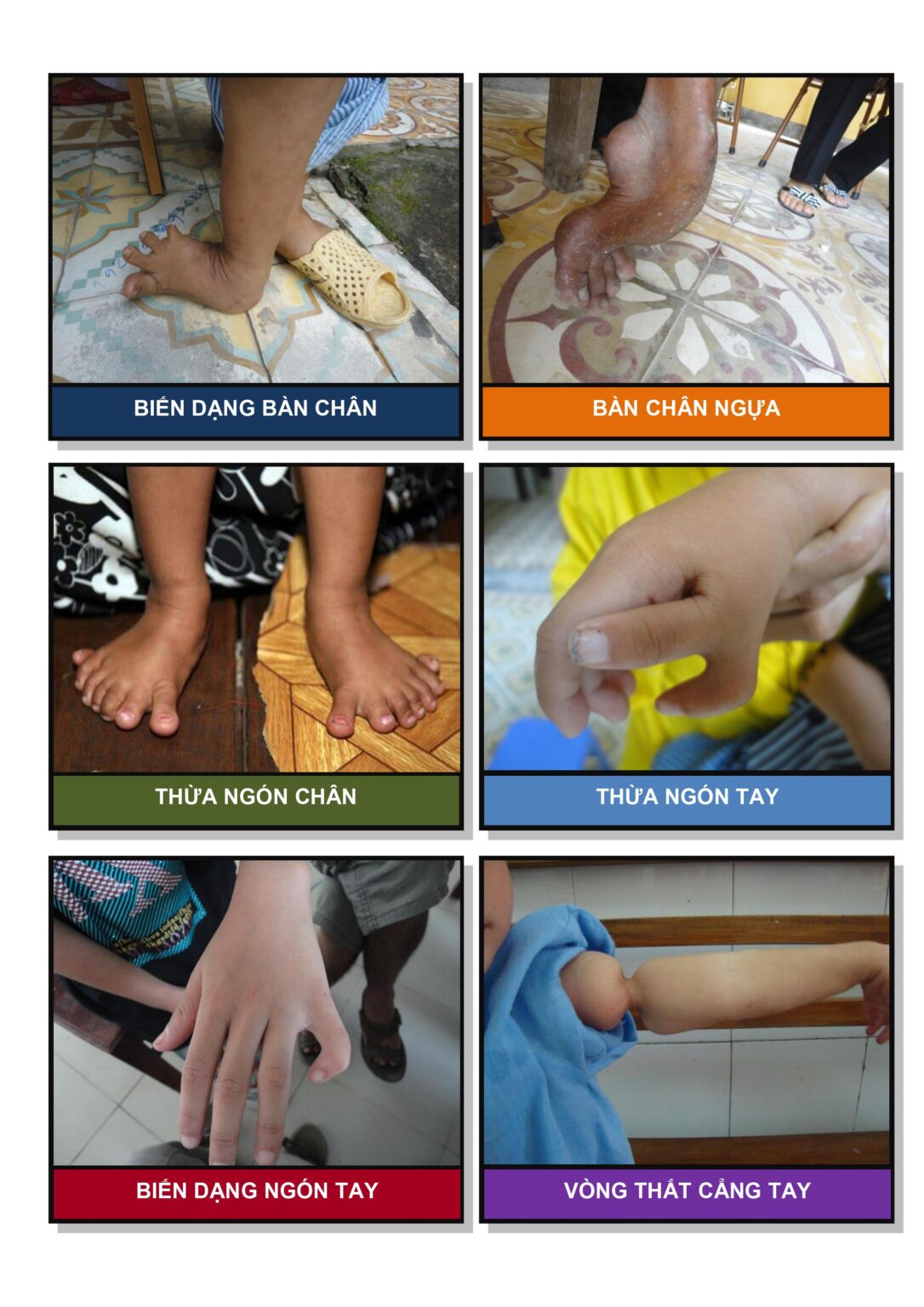 Nhận dạng trẻ khuyết tật có nhu cầu phẫu thuật Trung tâm II – Địa chỉ ...