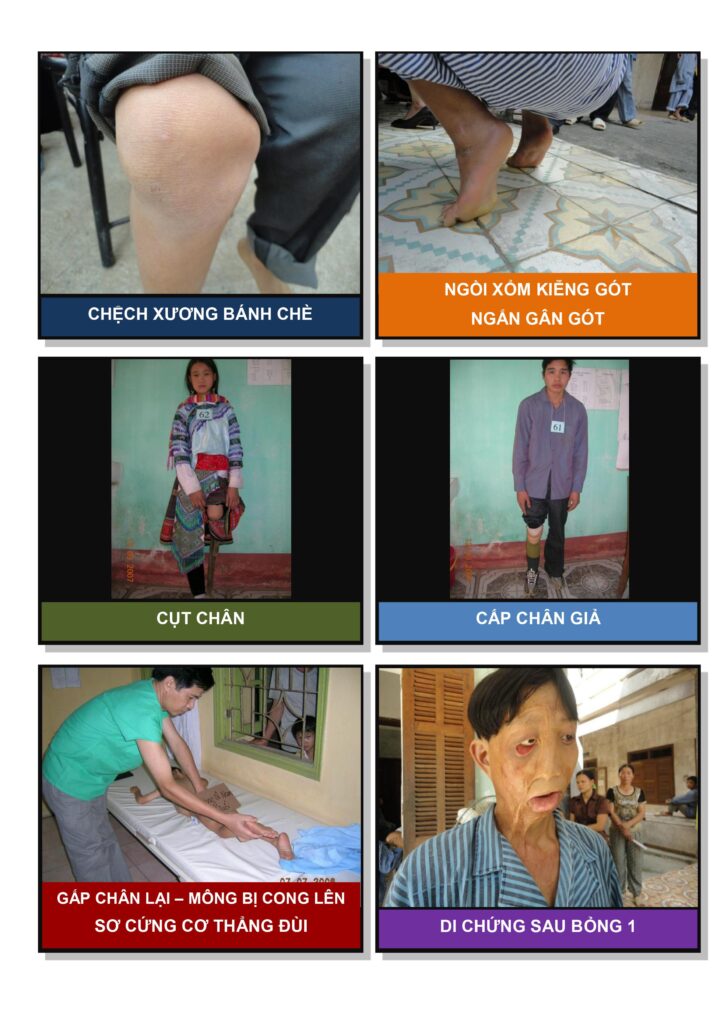 Nhận dạng trẻ khuyết tật có nhu cầu phẫu thuật Trung tâm II – Địa chỉ ...
